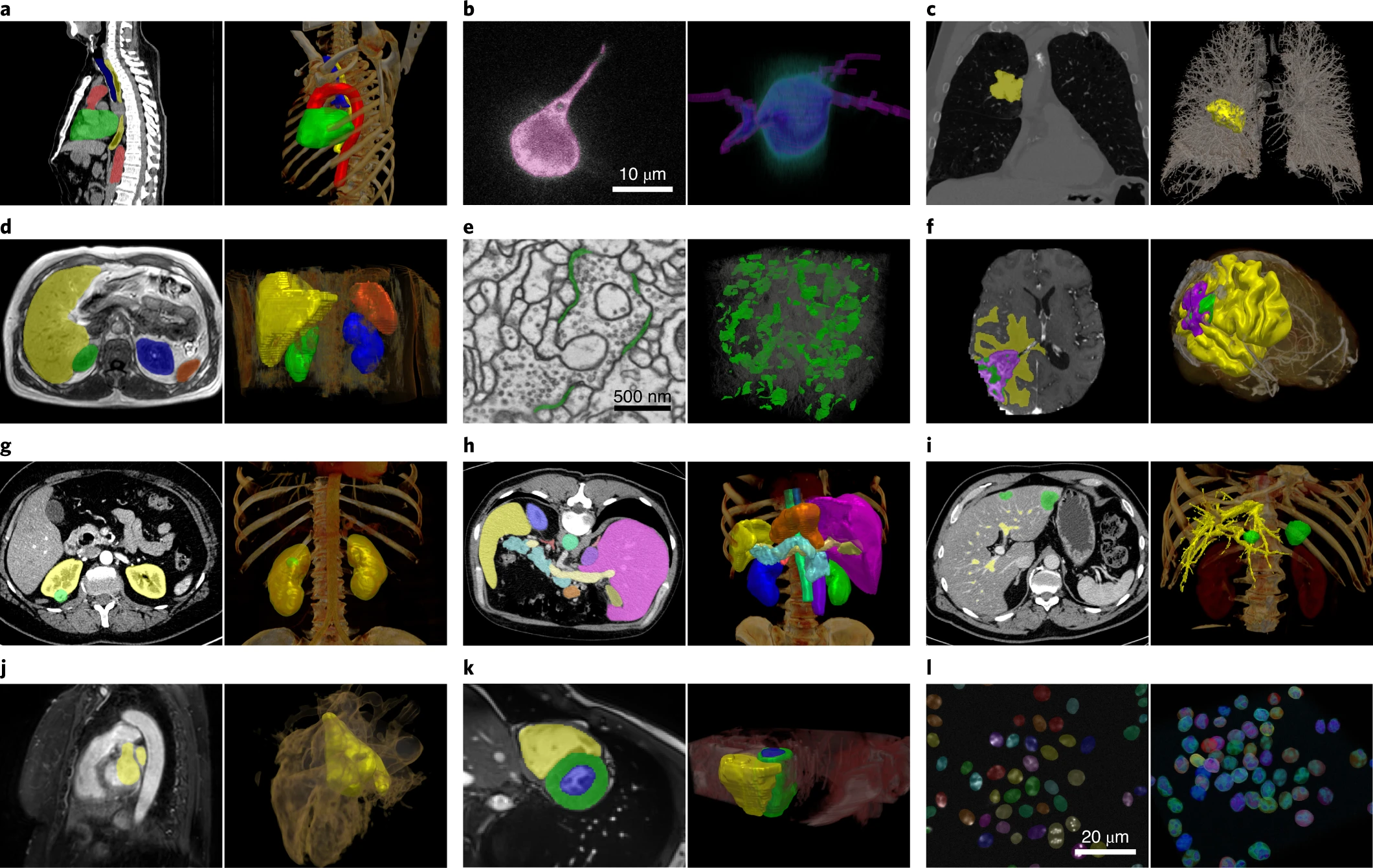 nnU-Net: a self-configuring method for deep learning-based biomedical image segmentation – NMMItools