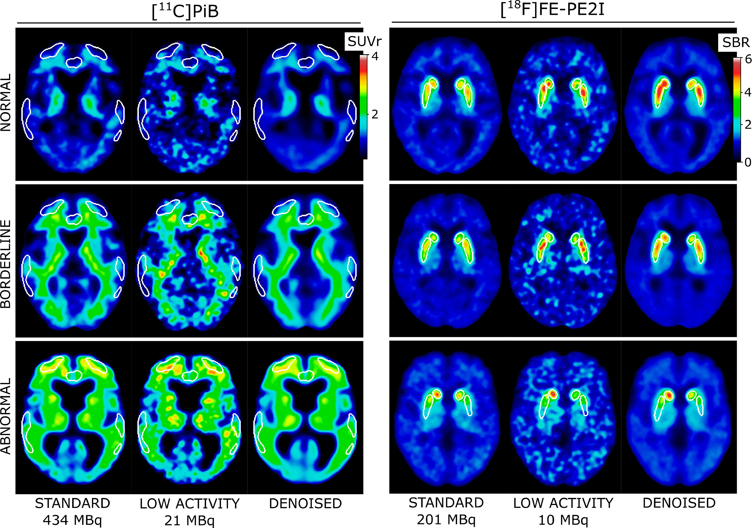 brainPETNR: Brain PET Noise Reduction using a Frequency Attention ...