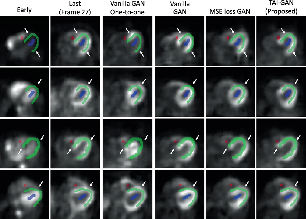 TAI-GAN: Temporally and Anatomically Informed GAN for early-to-late ...