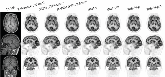 Model-based deep learning PET image reconstruction using FBSEM – NMMItools